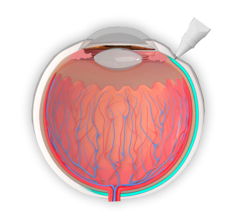 Technology – Clearside Biomedical