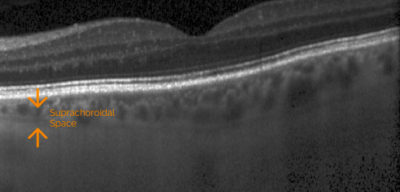 Suprachoroidal Space – Clearside Biomedical