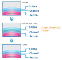 Suprachoroidal Space – Clearside Biomedical