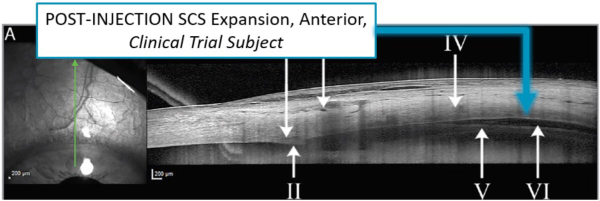 Preclinical Development – Clearside Biomedical