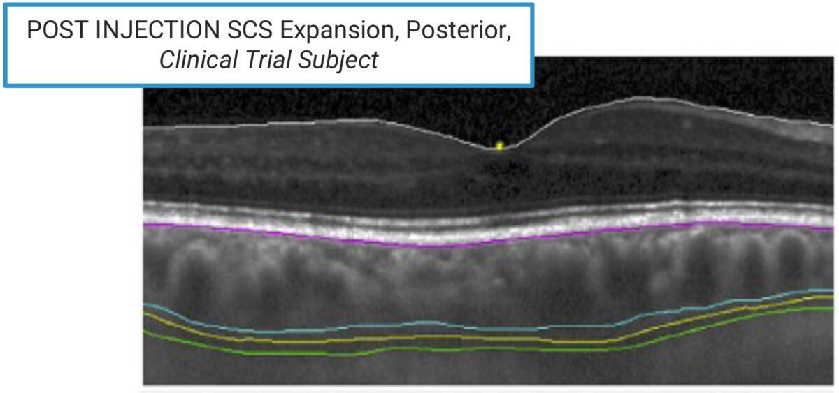 Preclinical Development – Clearside Biomedical