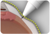 SCS Microinjector® – Clearside Biomedical