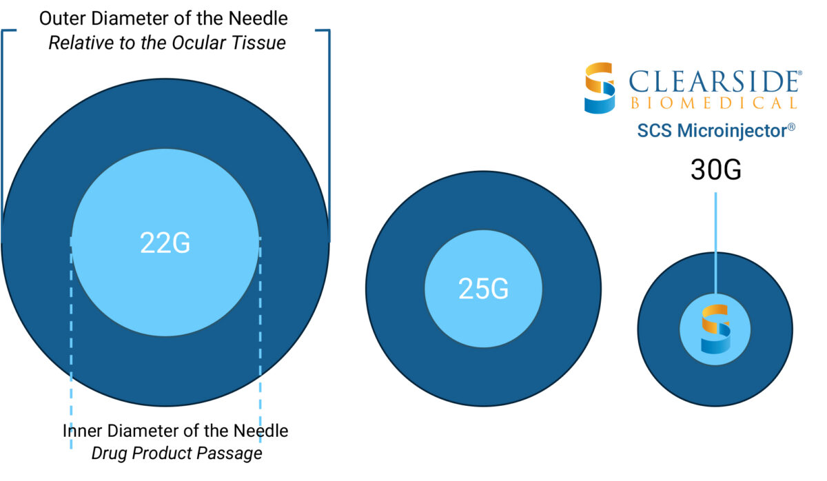 SCS Microinjector® – Clearside Biomedical